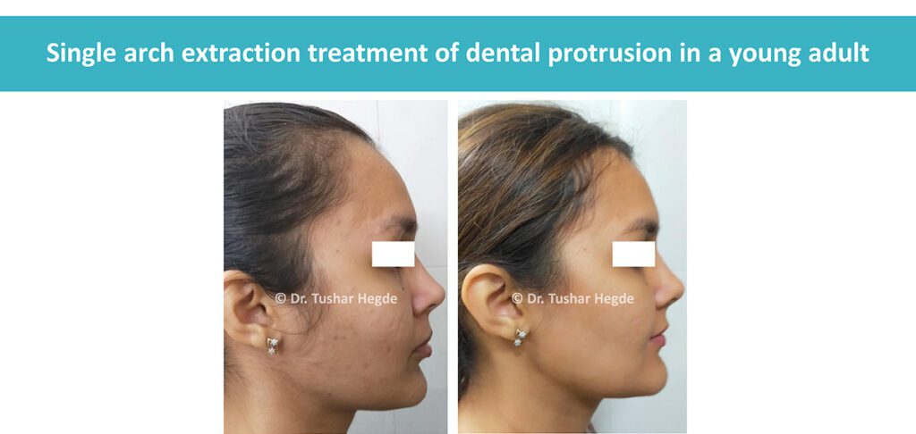 Single arch extraction treatment of dental protrusion in a young adult ...