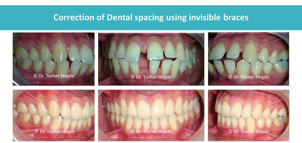 Correction of Dental spacing using invisible braces | Asha Advanced ...