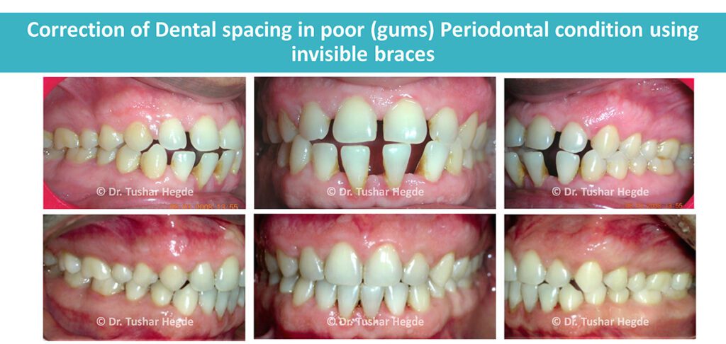 Correction of Dental spacing in poor (gums) Periodontal condition using ...